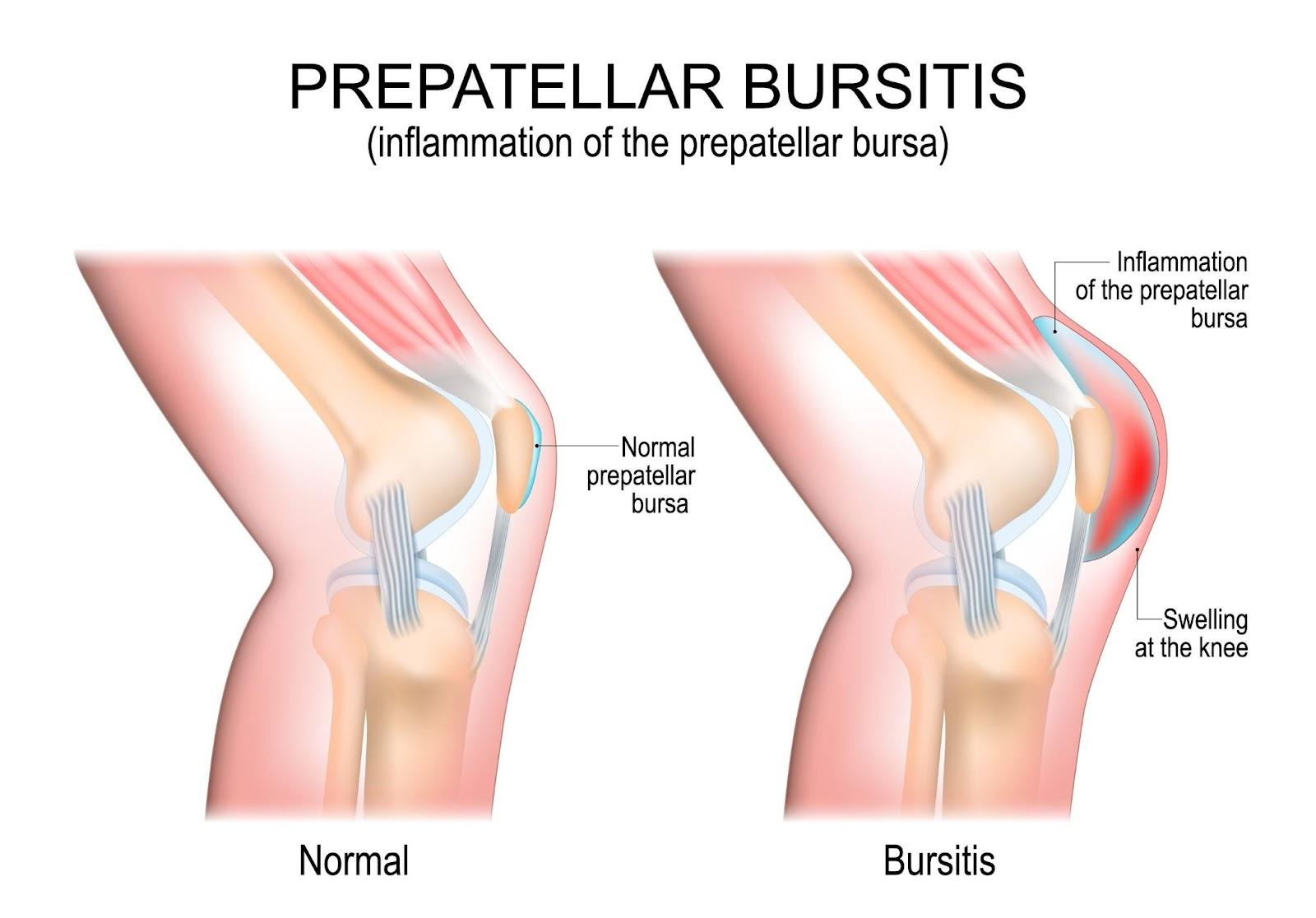Patellar bursitis store